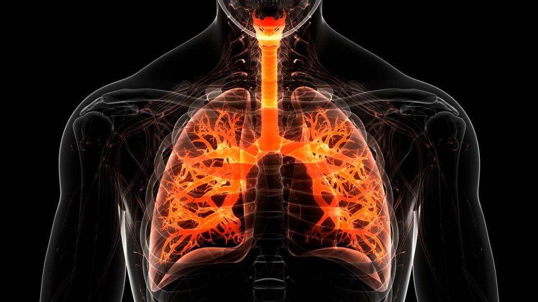 Quest Ce Que La Dilatation Des Bronches Ou Dcp Symptômes Et